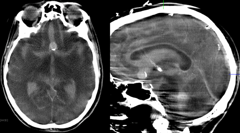 ACOM Rerupture Angio Coiling | neuroangio.org